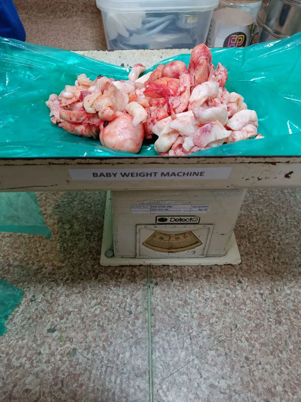 Mumbai Team Removes 1.25‑kg Fibroid Uterus Via Keyhole Surgery - BW ...