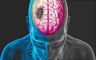 Identifying Stroke in Time and Life After Stroke - BW Healthcare World