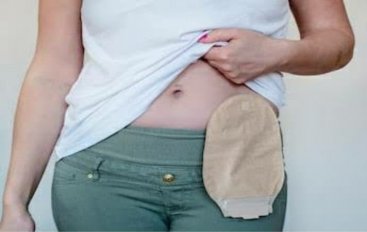 Connected ecosystem for Ostomy patients in a digital world - BW ...