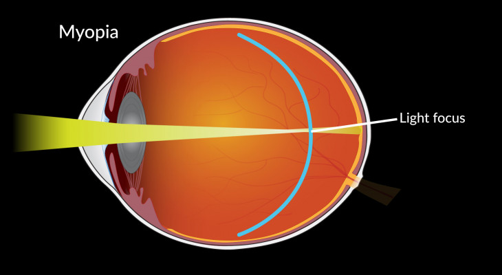 Myopia Surge In Indian Children Linked To Increased Screen Time ...