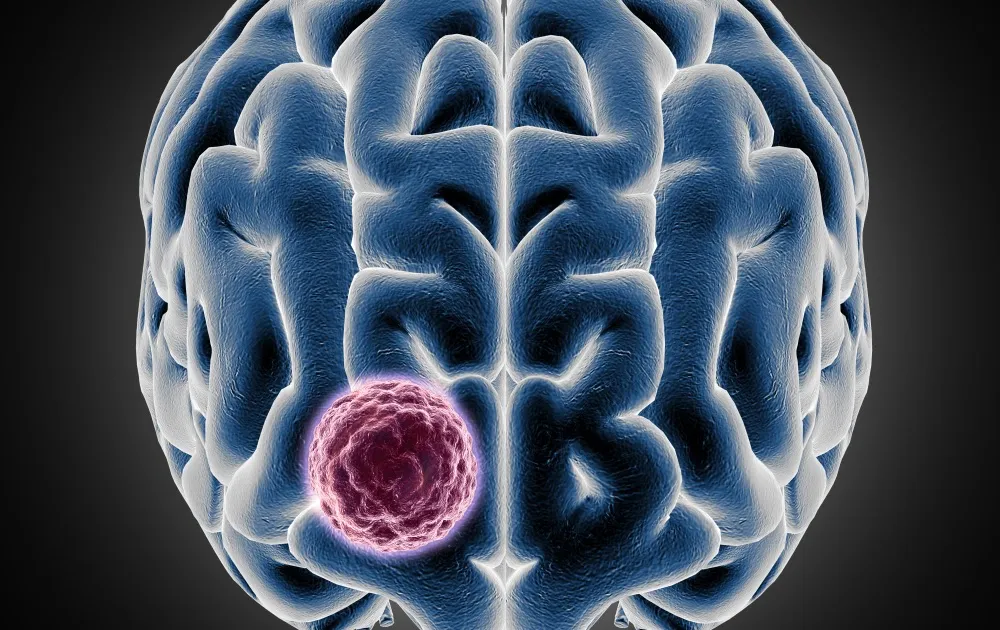 Revolutionising Brain Tumour Diagnosis With Molecular & Genetic Testing ...