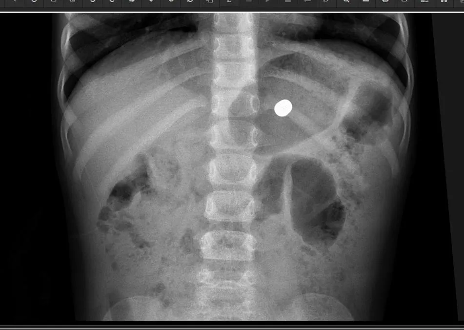 Siblings Undergo Emergency Surgeries After Swallowing Toy Magnets - BW ...
