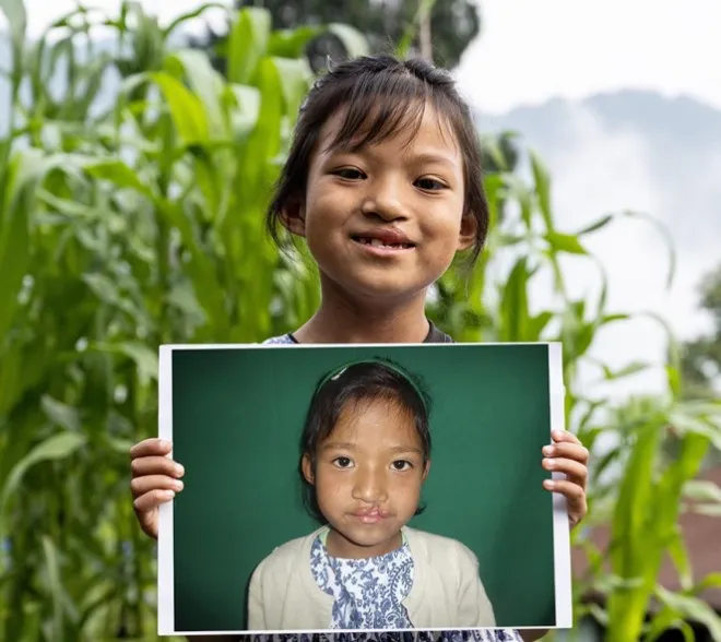 A New Smile For India: The Journey To Overcome Cleft Lip & Palate - BW ...