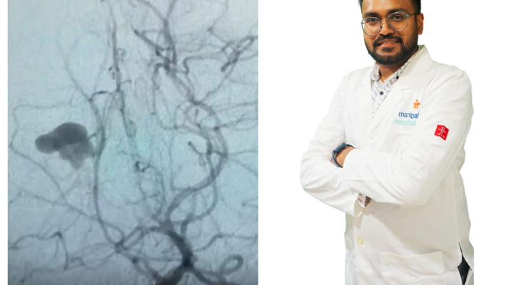 Manipal Bhubaneswar Performs Odisha’s First Hand-artery Brain Aneurysm ...
