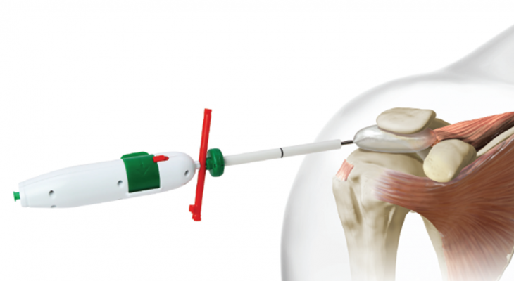 Stryker Introduces InSpace, A Biodegradable Balloon Implant For Rotator ...