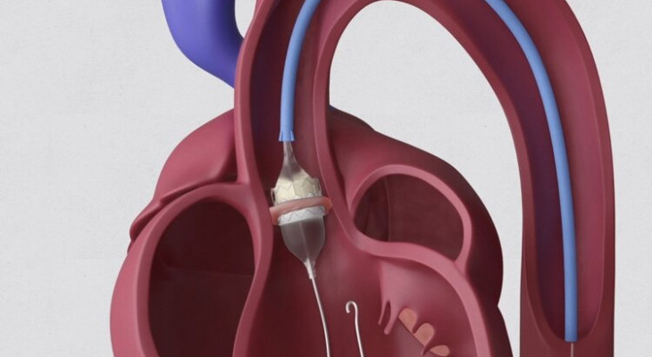 Zydus MedTech, Braile Biomedica Ink Global Pact For TAVI Technology ...