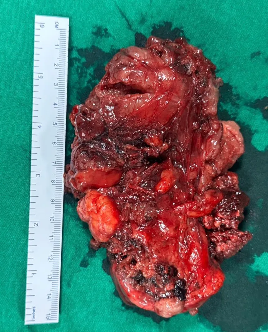 Sahyadri Hospital Removes World’s Largest Ectopic Thyroid Tumor With ...