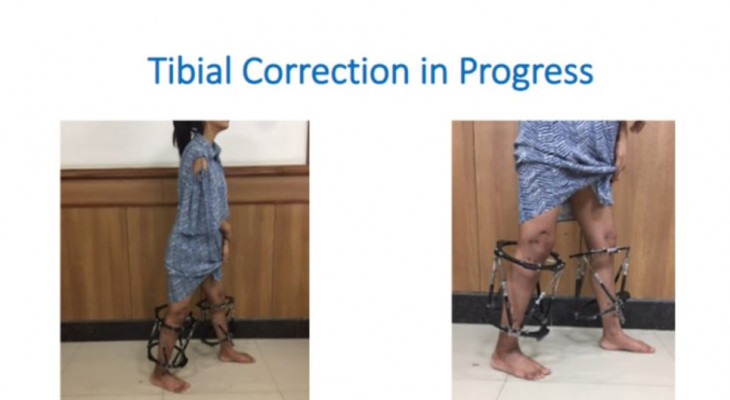 Sir Ganga Ram Hospital's Orthopedic Team Transforms Life Of Teen With ...