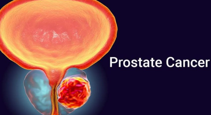 Prostate Cancer And The Importance Of Early Screening - BW Wellbeing World