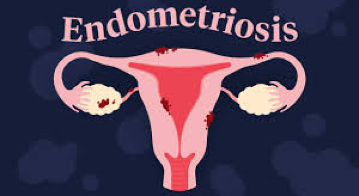 P.D Hinduja Hospital Launches Dedicated Endometriosis Clinic In Mumbai ...