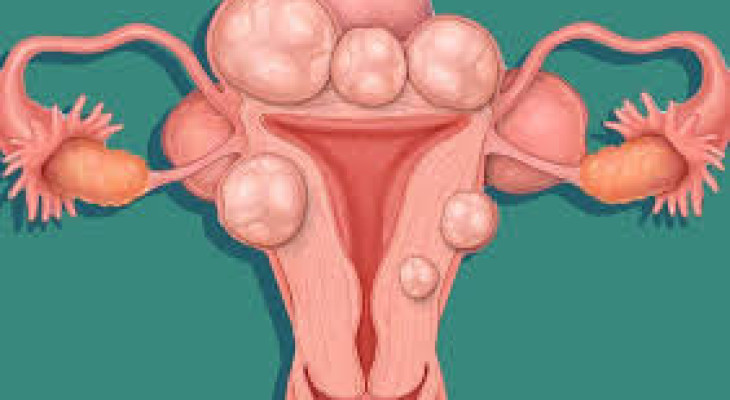 The Hidden Burden Of Fibroids: Millions Of Women, Few Conversations ...