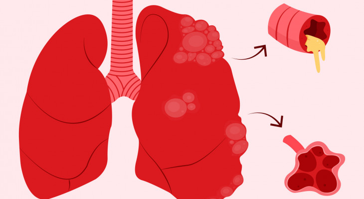 Geri Care Hospital Performs Tamil Nadu’s First Mechanical Thrombectomy ...