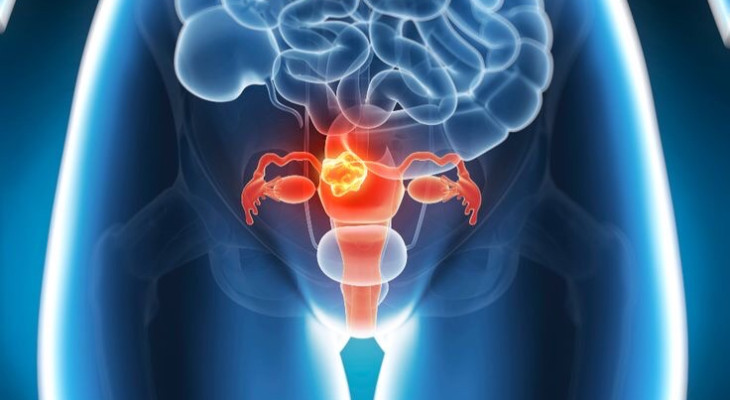 Fibroid Embolisation: A Uterus-Saving Solution Women Need To Know About ...