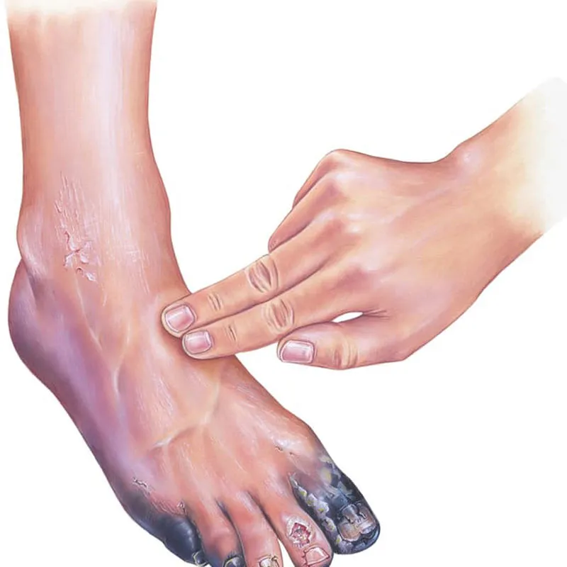 Silent Threat: Why PAD Awareness Can Save Legs & Lives - BW Healthcare ...