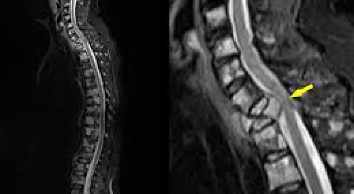 The Weak Handshake Signal: When Hand Weakness Could Mean Spinal Cord ...