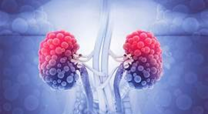 Understanding Genetic Kidney Disorders - BW Healthcare World