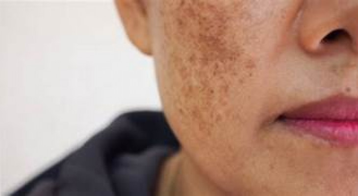 Over 80% Of Indian Women Affected By Skin Color Heterogeneity: Study ...