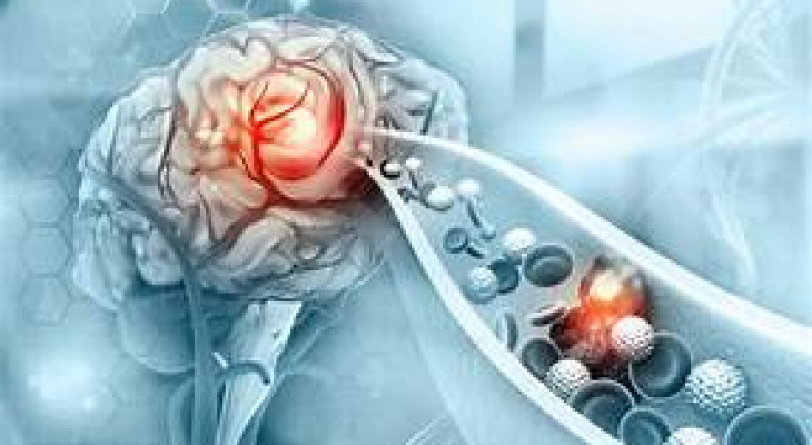 Understanding The Warning Signs Of A Stroke: Acting FAST Can Save Lives ...