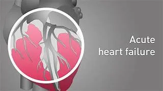 Impella In Acute Heart Failure: Indications, Benefits,& Challenges In ...