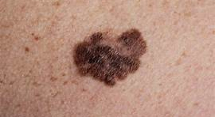 AI Tool ‘DeepMerkel’ Predicts Outcomes Of Aggressive Skin Cancer - BW ...
