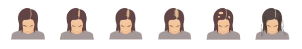 Are You Neglecting The Early Signs Of Extreme Hair Fall? - BW ...